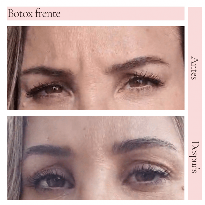 Botox: Mi experiencia, opinión y el antes y después | Srta Palo